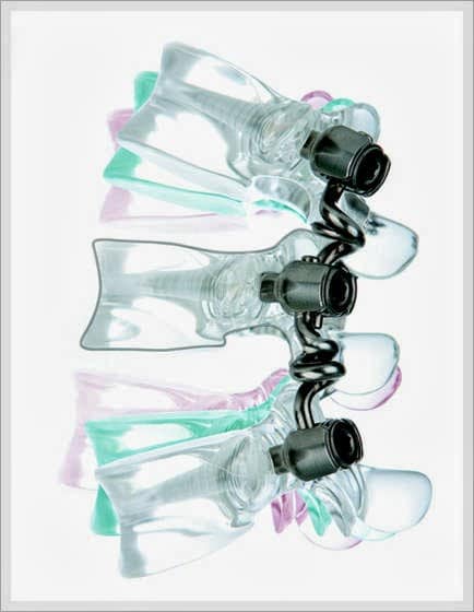 Bioflex System - SPINEMarketGroup