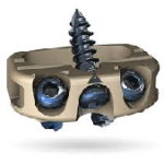 Anterior Lumbar Interbody Fusion Cages (ALIF) Archives - SPINEMarketGroup