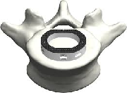 Tyber Medical ALIF - SPINEMarketGroup