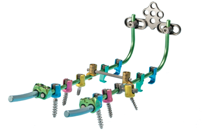 Nex-Link® Spinal Fixation System - SPINEMarketGroup