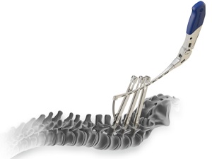 CD Horizon Solera Voyager spinal system - SPINEMarketGroup