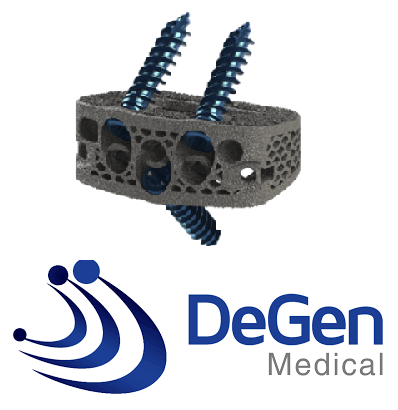 DeGen Medical Launches 3D-printed ALIF implant at Texas Back Institute ...