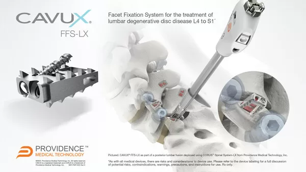 Providence Medical Technology Announces FDA Clearance of CAVUX® FFS-LX ...