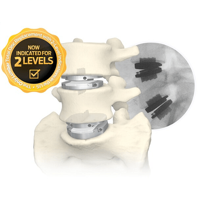 Coverage Expansion Continues for One- and Two-level Lumbar Total Disc ...