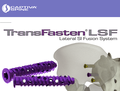 Captiva Spine® Introduces TransFasten® LSF, Lateral Si Fusion System ...