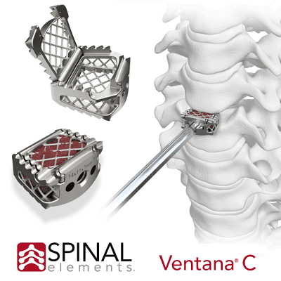 Ventana® C: New 3D Cervical Interbody Implant from Spinal Elements - SPINEMarketGroup