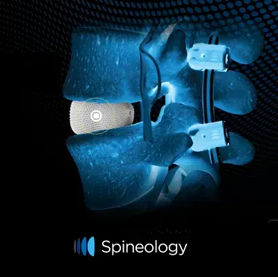 Spineology® Announces the Launch of OptiMesh Align™ - SPINEMarketGroup